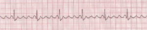 Stable vs. Unstable Tachycardia - ACLS Online Handbook