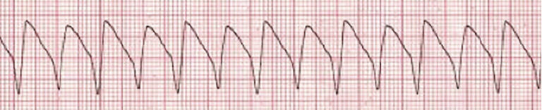 Arrhythmia Ventricular Fibrillation-Pulseless Ventricular Tachycardia