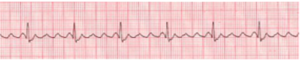 Stable vs. Unstable Tachycardia – Advanced Medical Certification