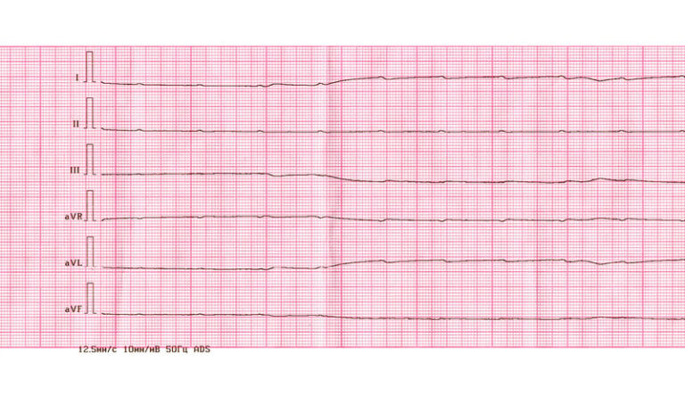 PEA Arrest Uncovered: The Vital Steps to Save a Failing Heart