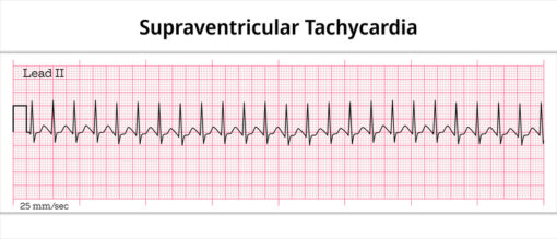 Vagal Maneuvers Made Simple: Combat SVT Without Meds