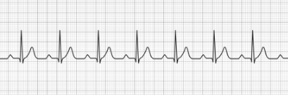 ACLS Rhythms and Interpretation - Advanced Medical Certification